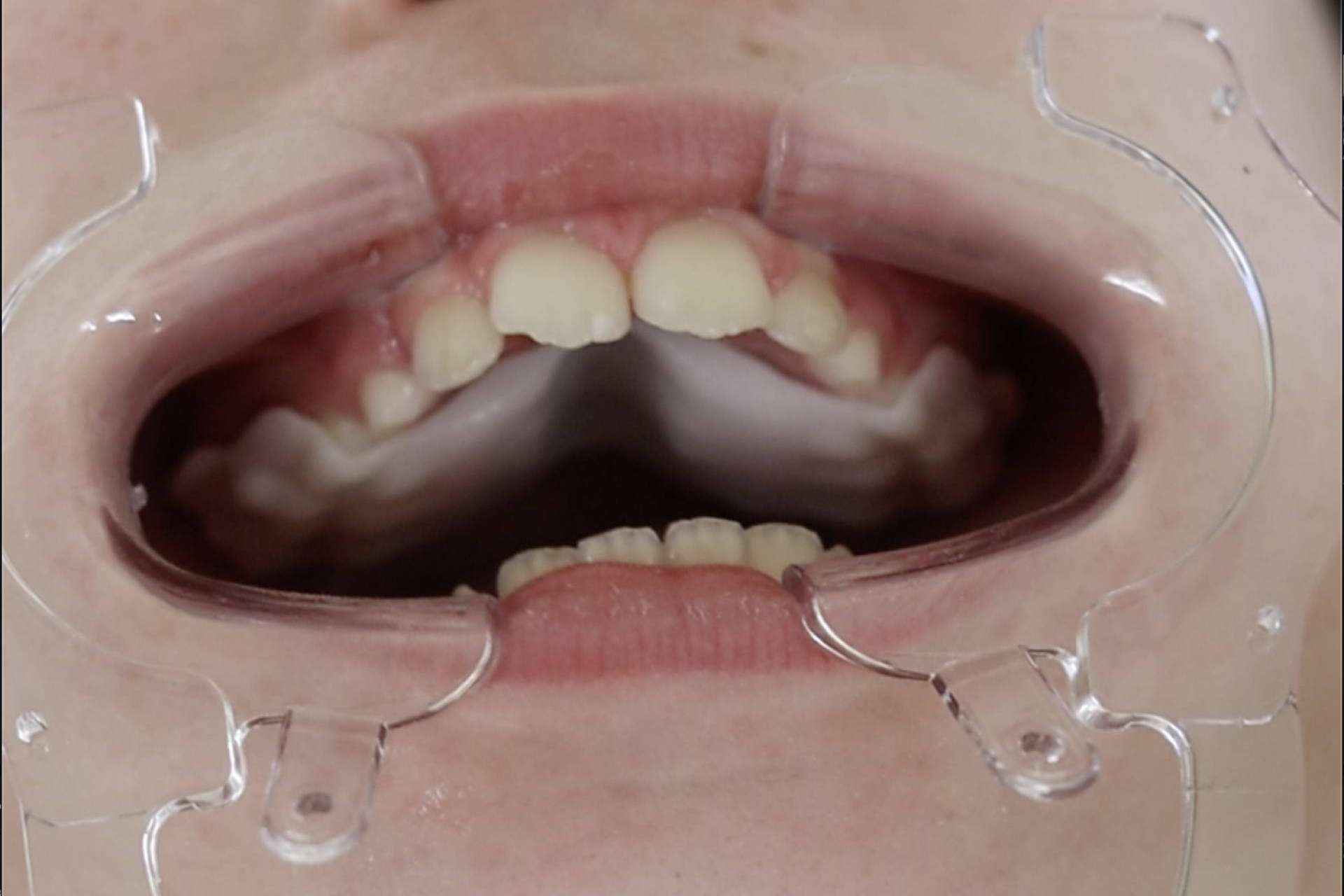 Smart Aligner Services da la bienvenida al Palatal Expander en su ...